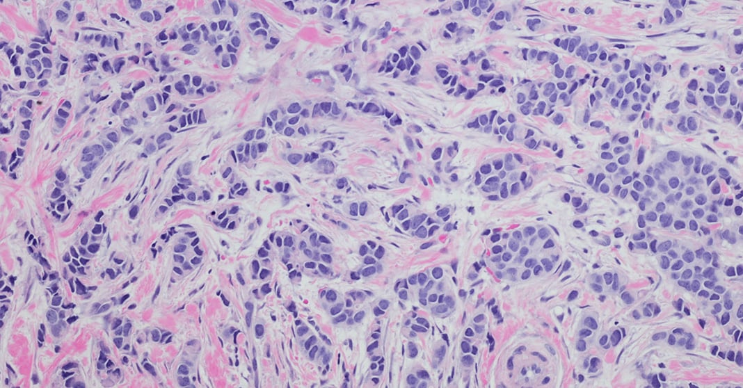 Immunohistochemistry: a Powerful Tool in Cancer Research